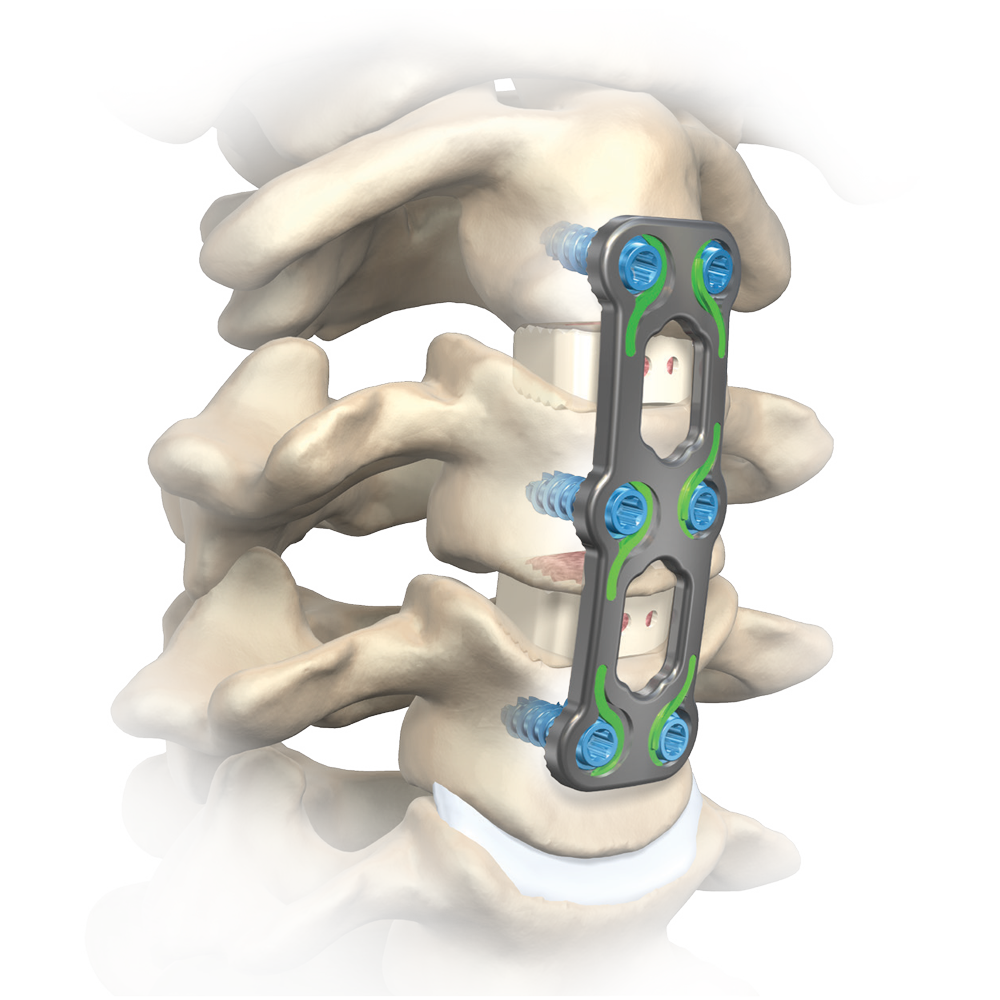 AllianceSpine™ – Inspiring Solutions Through Innovation