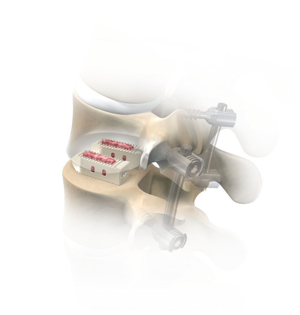 Alamo® P – AllianceSpine™