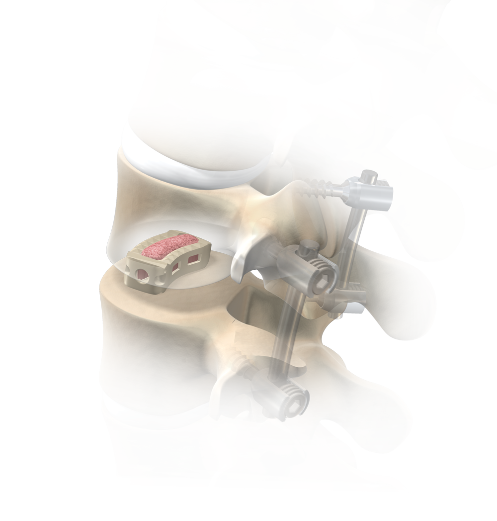 Alamo® T – AllianceSpine™